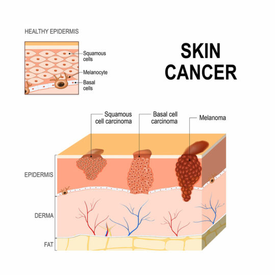 skin-cancer_diagram - Gulf Coast Woman Magazine