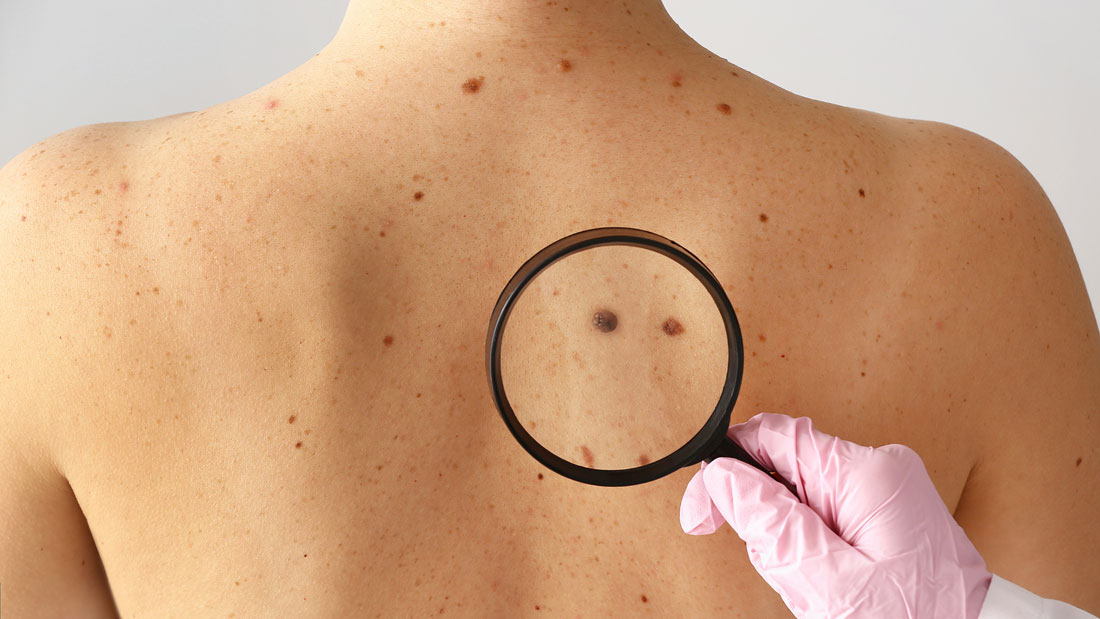 skin-cancer-know-facts_back-magnifying-glass - Gulf Coast Woman Magazine